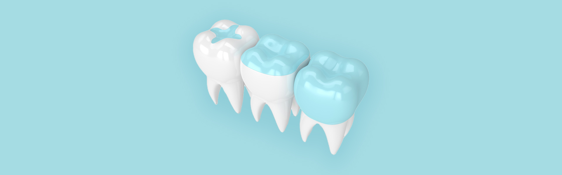 Everything You Need to Know About Dental Inlay and Onlay: Treatment and ...