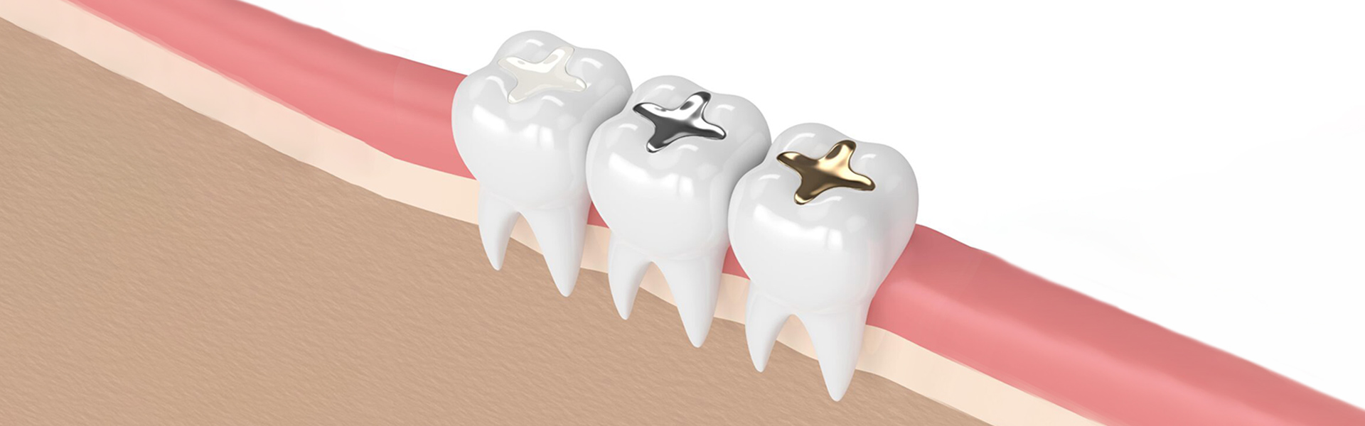 How Inlays and Onlays Help Restore Damaged Teeth?