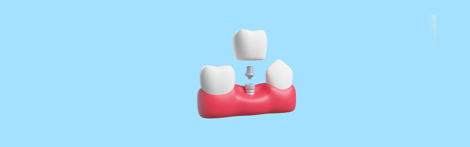 Dental Implants: The Most Natural Solution for Missing Teeth